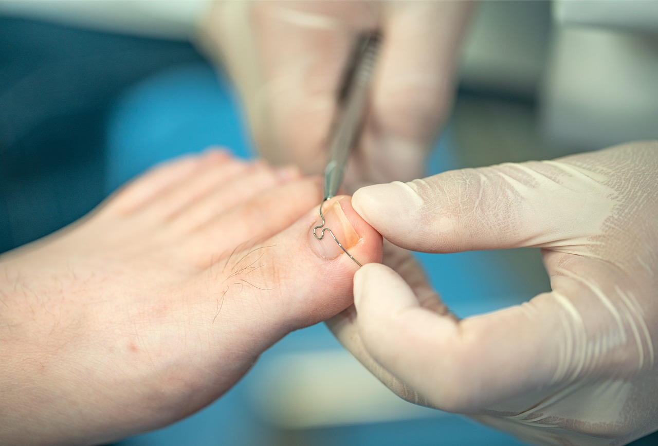 Ingrown Toenail Treatment Batley - Podocare